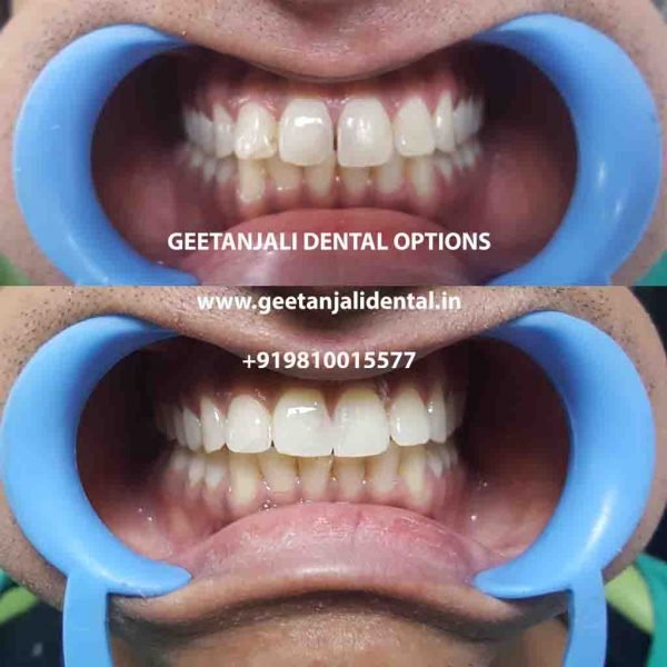 Instant Gap Closure | Geetanjali Dental Options
