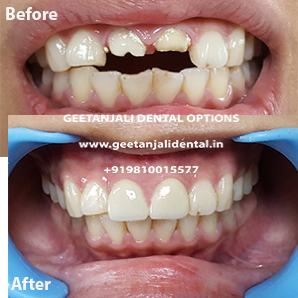 Painless Best Root Canal Treatment in Delhi by RCT Specialist